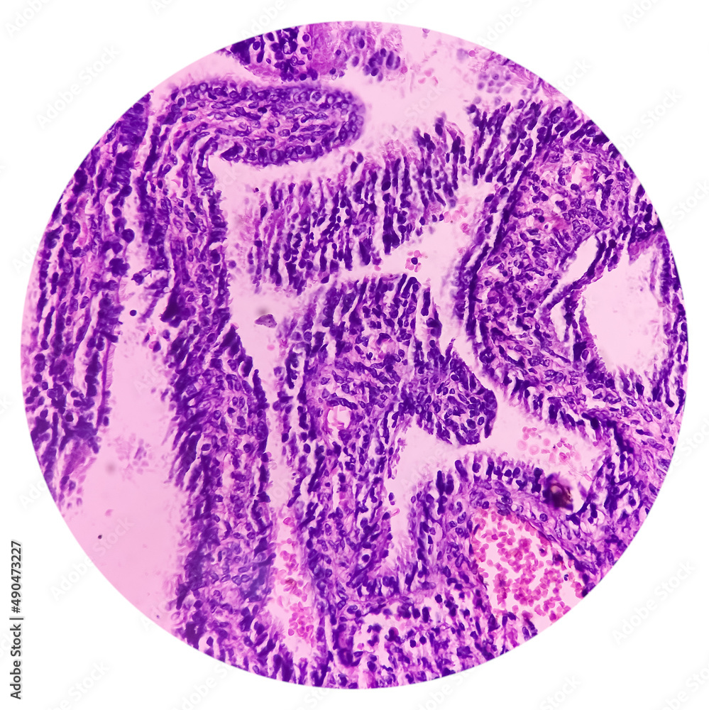 Ovarian Cyst Wall Luteal Cyst Photo Under Microscope Photograph ovarian-cyst-wall-luteal-cyst-photo-under-microscope-photograph