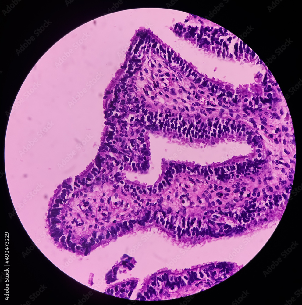 Ovarian cyst wall, luteal cyst, photo under microscope, photograph ...