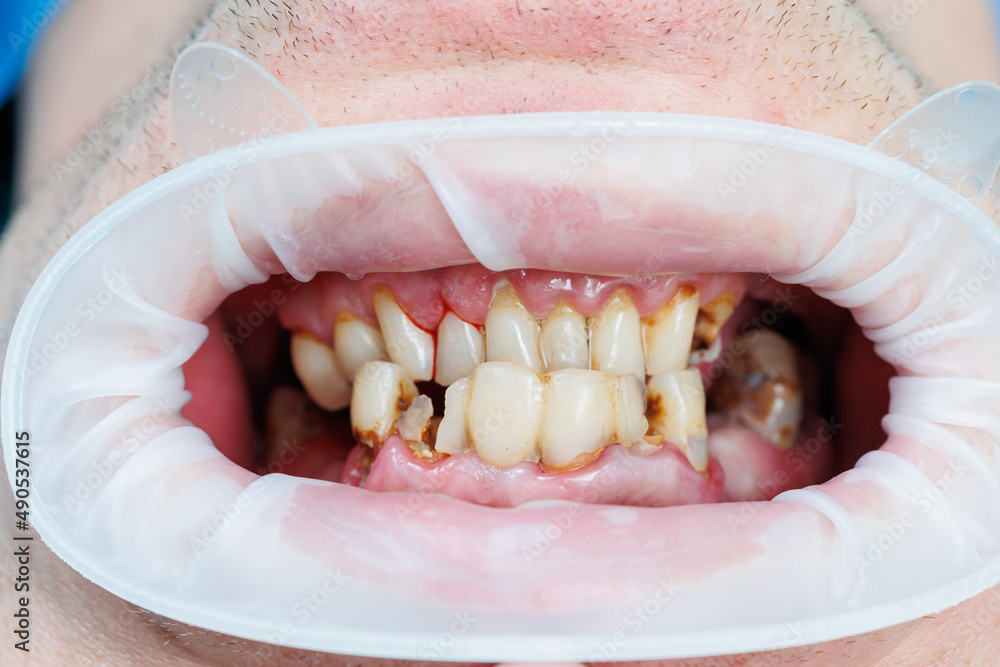 Spoiled teeth, poor dental hygiene, caries, Mouth disease. shattered ...