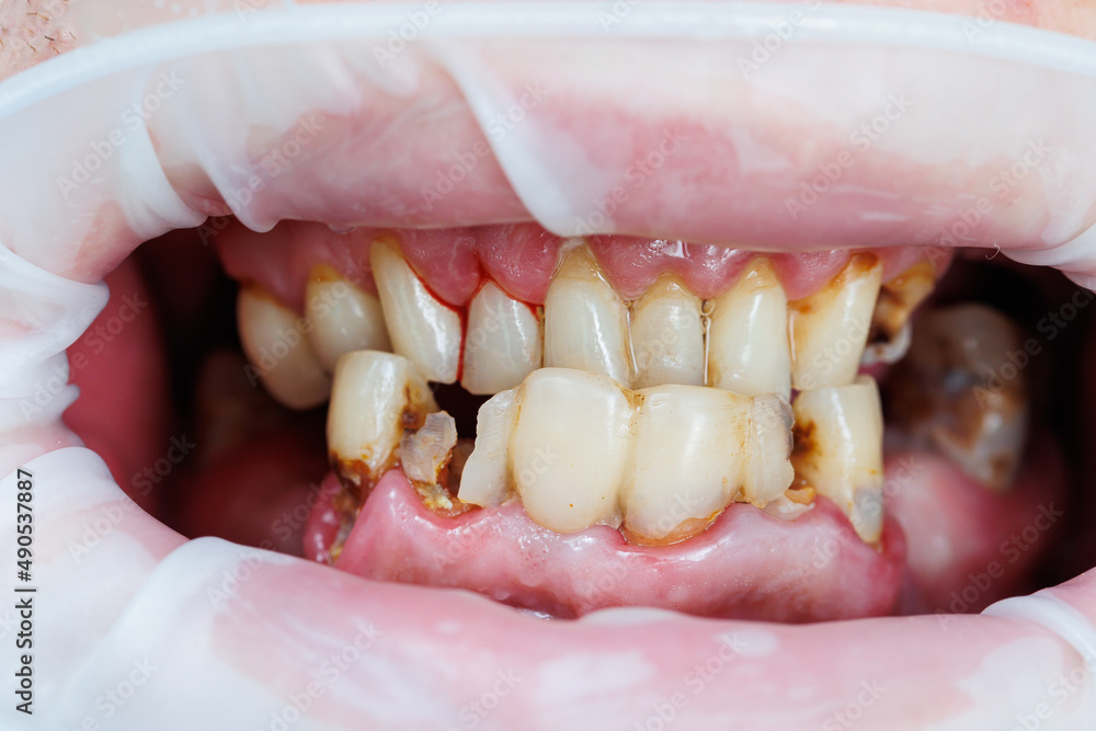 Spoiled teeth, poor dental hygiene, caries, Mouth disease. shattered ...