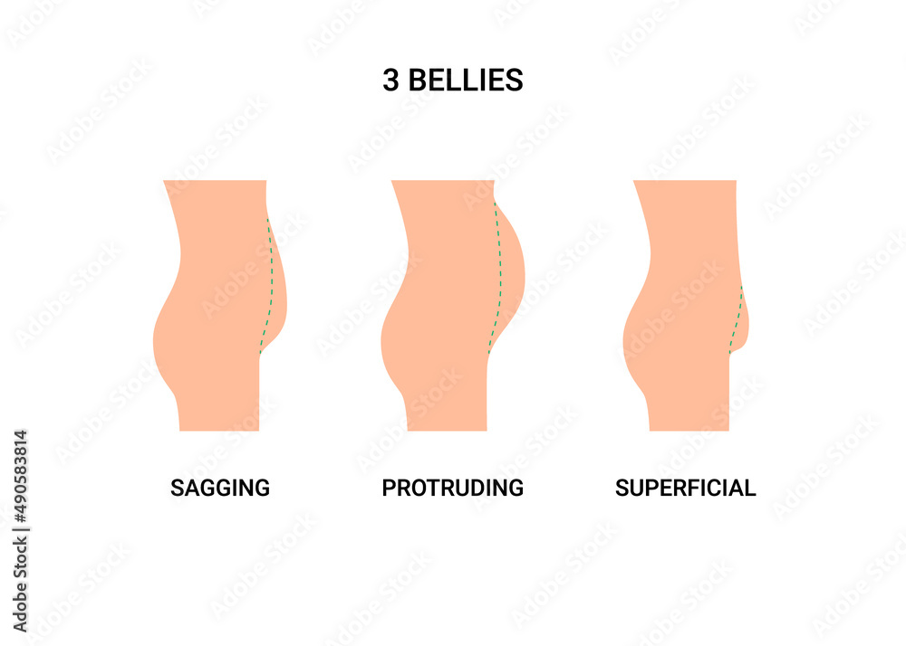 Types bellies of human body, big belly with overweight. Sagging ...