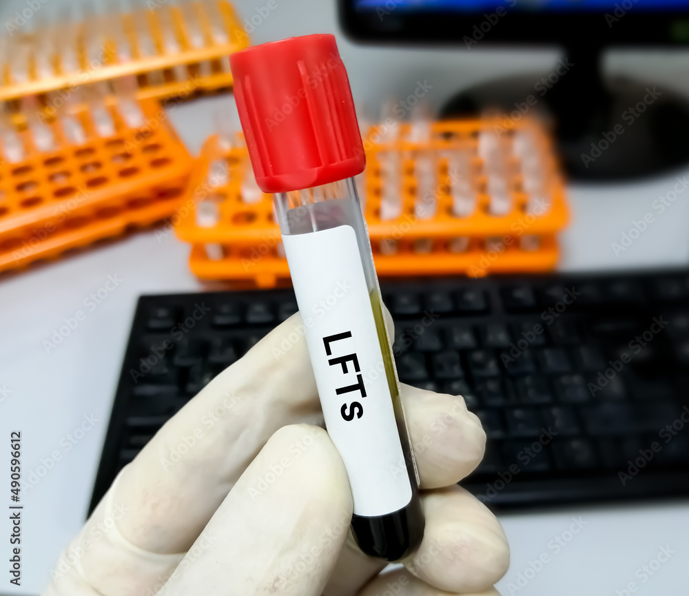 Blood Tube Test With Requisition Form For LFTs Or Liver Function Tests blood-tube-test-with-requisition-form-for-lfts-or-liver-function-tests