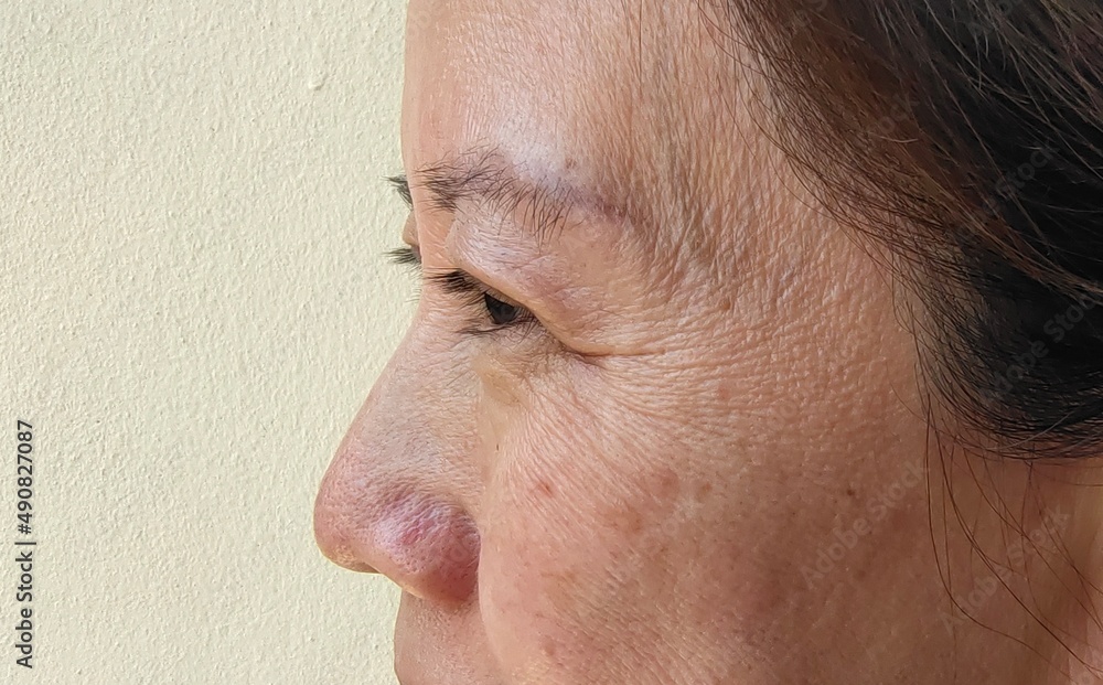 Portrait showing flabbiness and wrinkled skin beside the face, problem ...