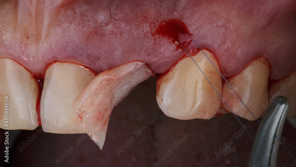 dental flap grafting into the gum after implantation of the central ...