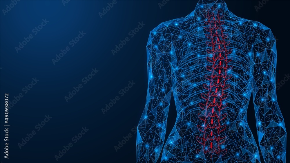 Scoliosis, curvature of the spine. Incorrect deformation of the human ...