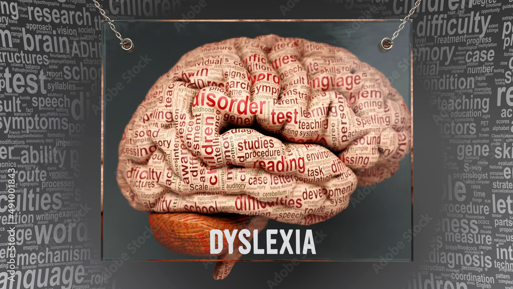Dyslexia anatomy - its causes and effects projected on a human brain ...