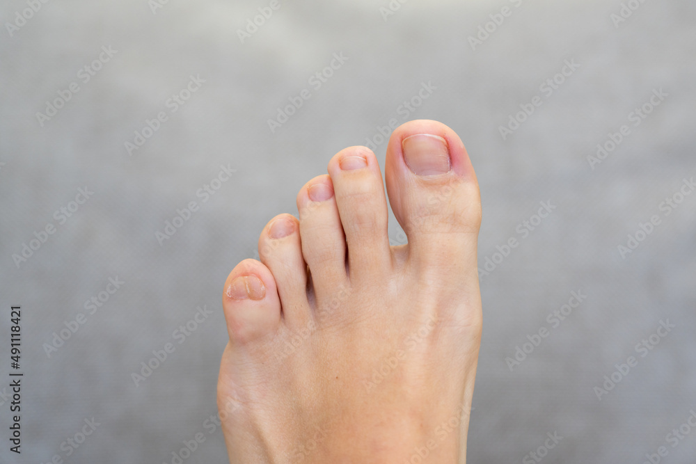 Female feet with big double little toe on grey background Stock Photo ...