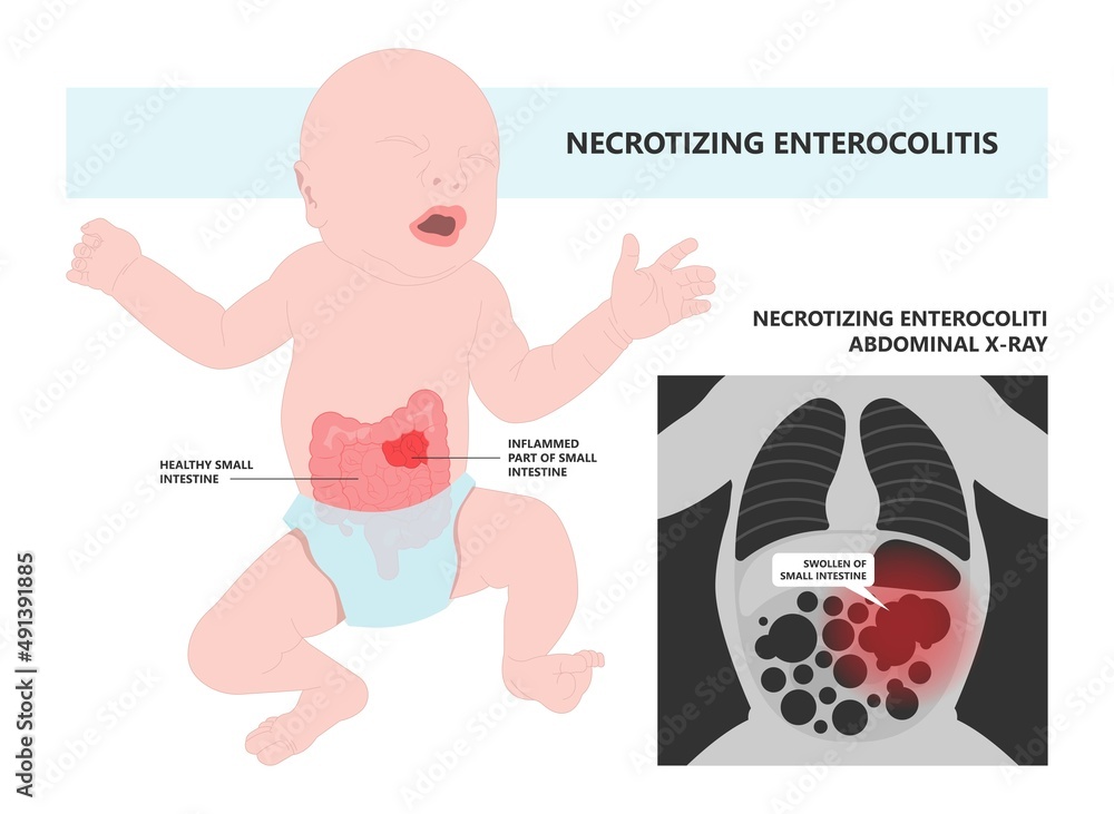 ileus bowel toxic small midgut cecal colon tract Hirschsprung's gastric ...