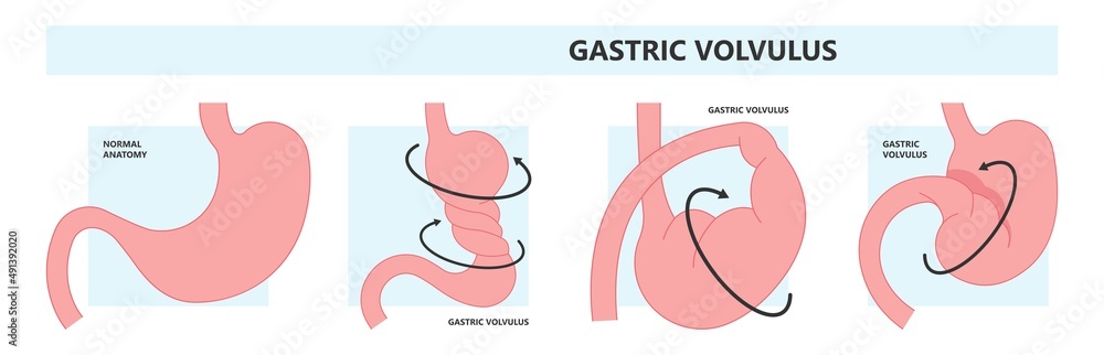 ileus bowel toxic small midgut cecal colon tract Hirschsprung's gastric ...