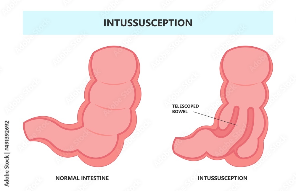 ileus bowel toxic small midgut cecal colon tract Hirschsprung's gastric ...