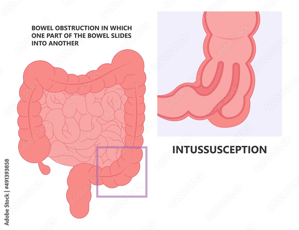 ileus bowel toxic small midgut cecal colon tract Hirschsprung's gastric ...