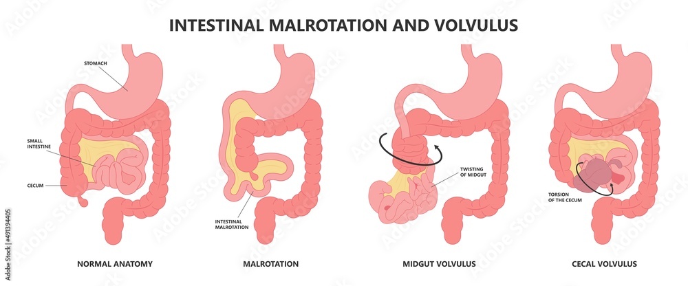 ileus bowel toxic small midgut cecal colon tract Hirschsprung's gastric ...