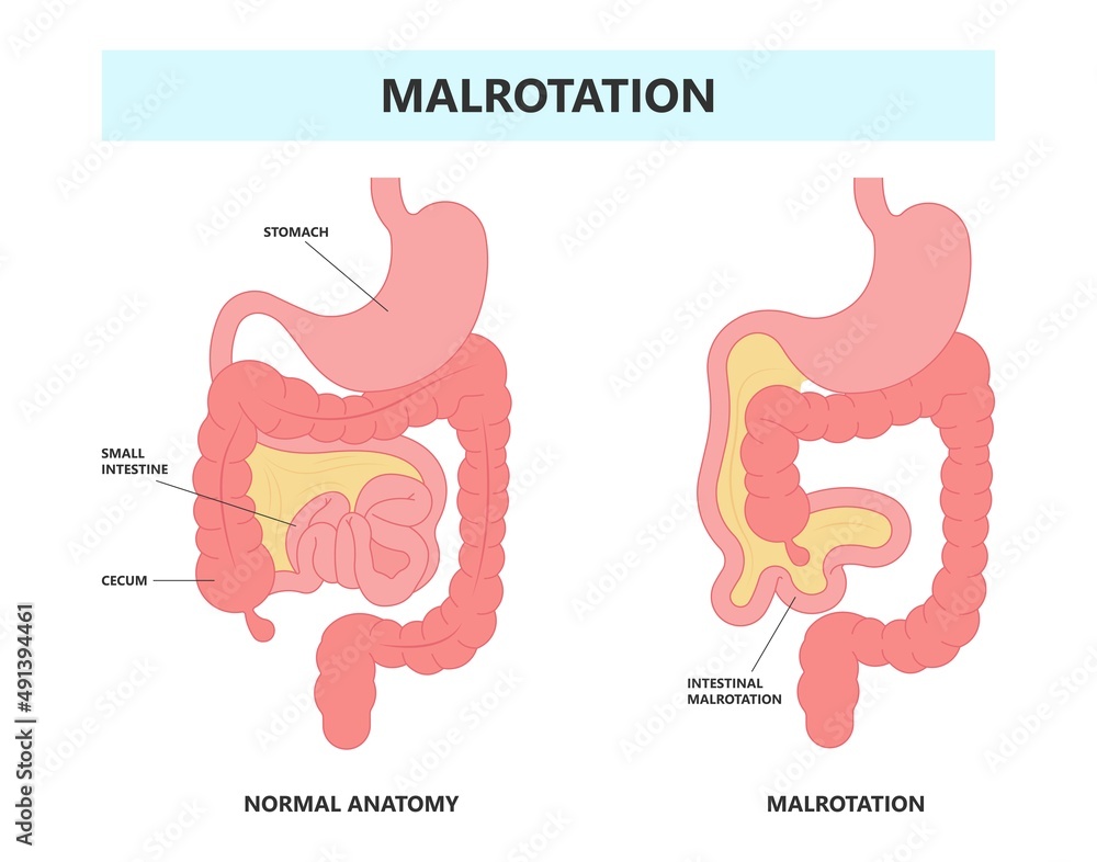 ileus bowel toxic small midgut cecal colon tract Hirschsprung's gastric ...