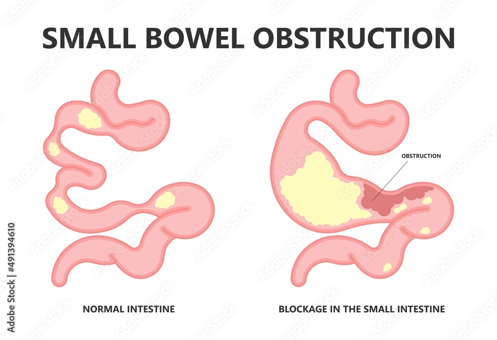 ileus bowel toxic small midgut cecal colon tract Hirschsprung's gastric ...