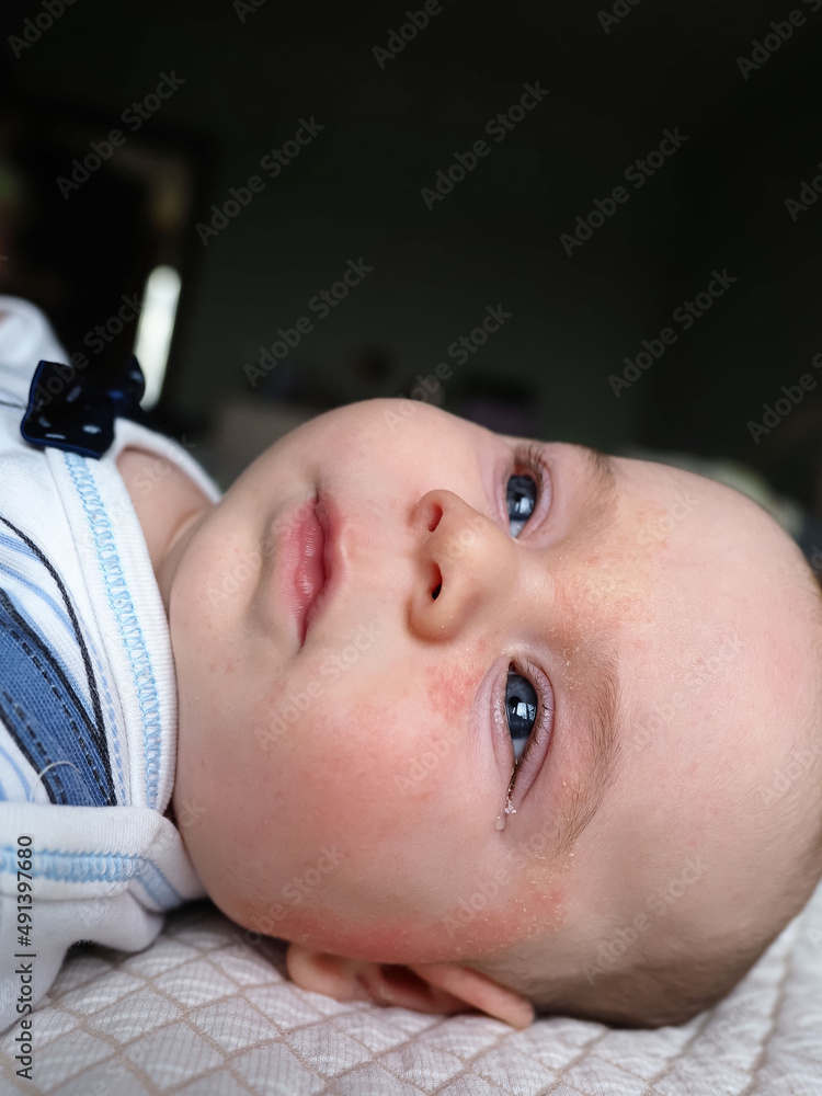 Atopic dermatitis child skin problem Stock Photo | Adobe Stock