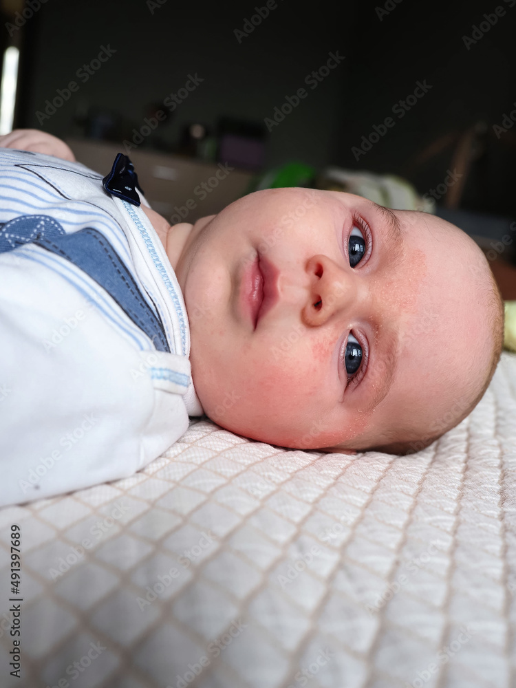 Atopic dermatitis child skin problem Stock Photo | Adobe Stock