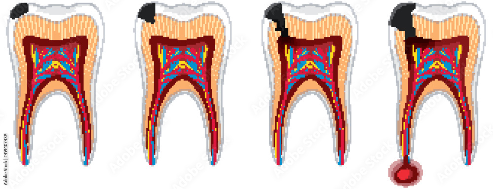 Human in the stages of tooth decay Stock Vector | Adobe Stock