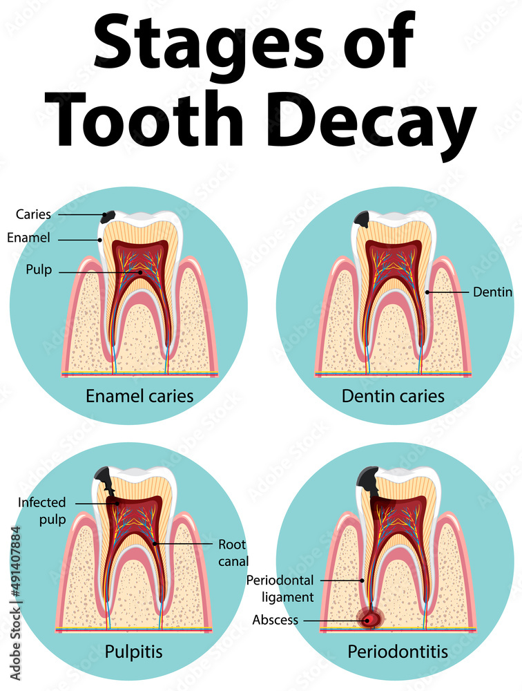 Infographic of human in the stages of tooth decay Stock Vector | Adobe ...