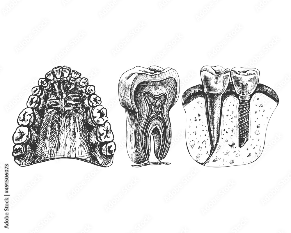 114_ jaw, teeth, gums, palate_dental implant_tooth structure, graphics ...