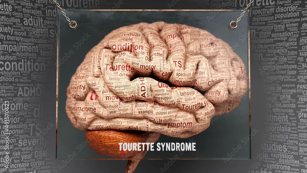 Stockillustratie Tourette syndrome anatomy - its causes and effects ...