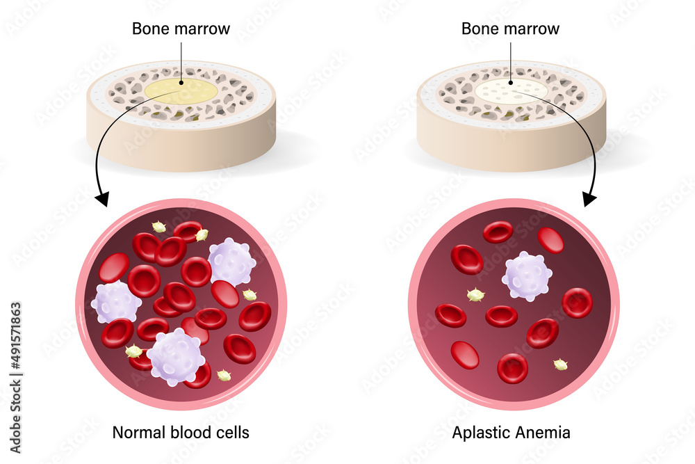 Aplastic anemia. The difference between normal blood and aplastic ...