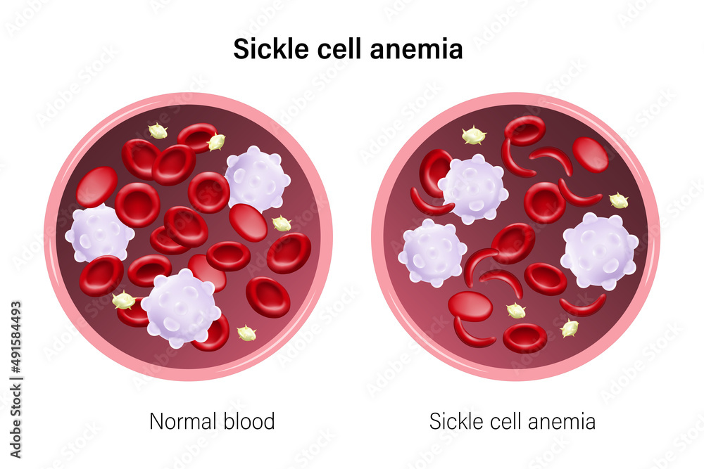 Sickle cell aemia. The difference of blood sickle cell aemia and normal ...