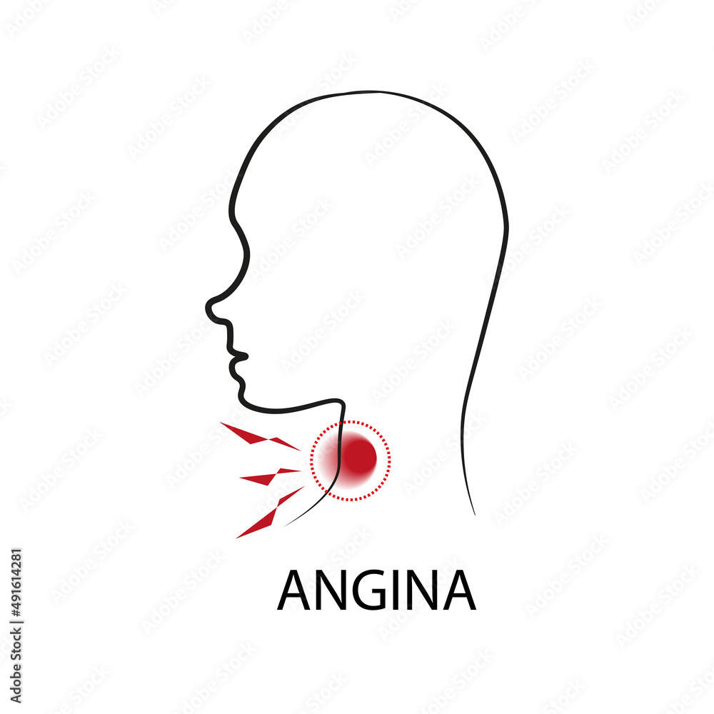Vector illustration of angina.Profile Silhouette with Ache Location ...