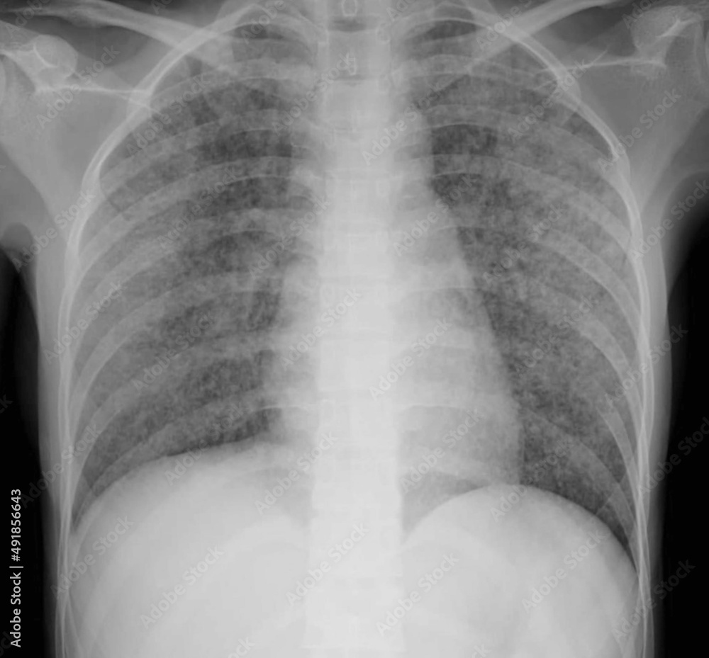 chest x-ray image of miliary nodules ภาพถ่ายสต็อก | Adobe Stock