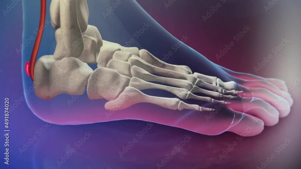 Achilles tendon Achilles Tendinitis animation 4k Stock Video | Adobe Stock