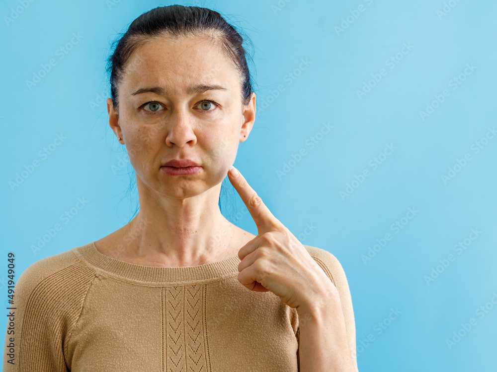 Foto Stock Teeth Problem. Gumboil, flux, bruise and swelling of cheek ...