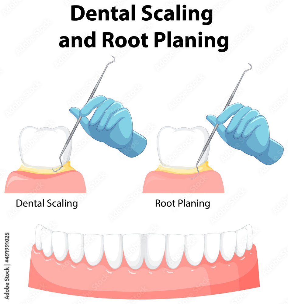 Infographic of human in dental scaling and root planing Stock Vector ...