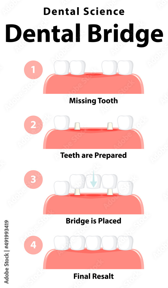Infographic of human in dental bridge Stock Vector | Adobe Stock
