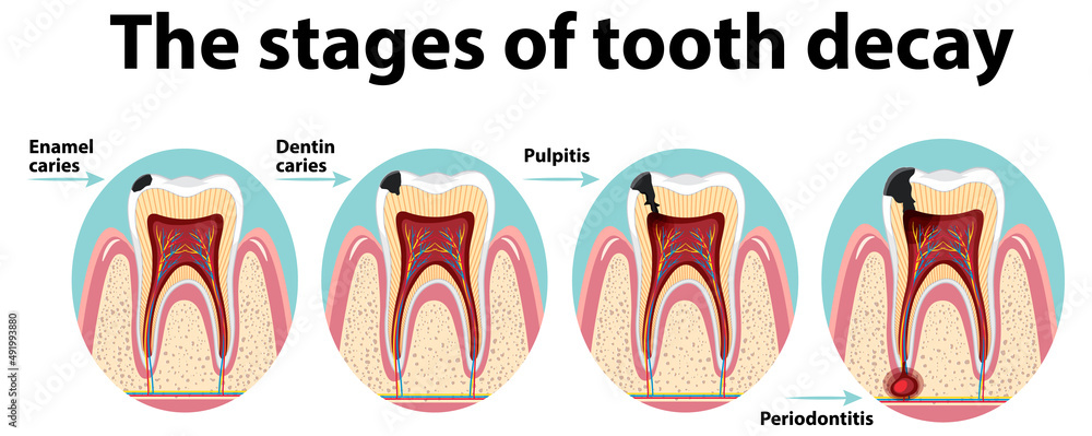 Infographic of human in the stages of tooth decay Stock Vector | Adobe ...