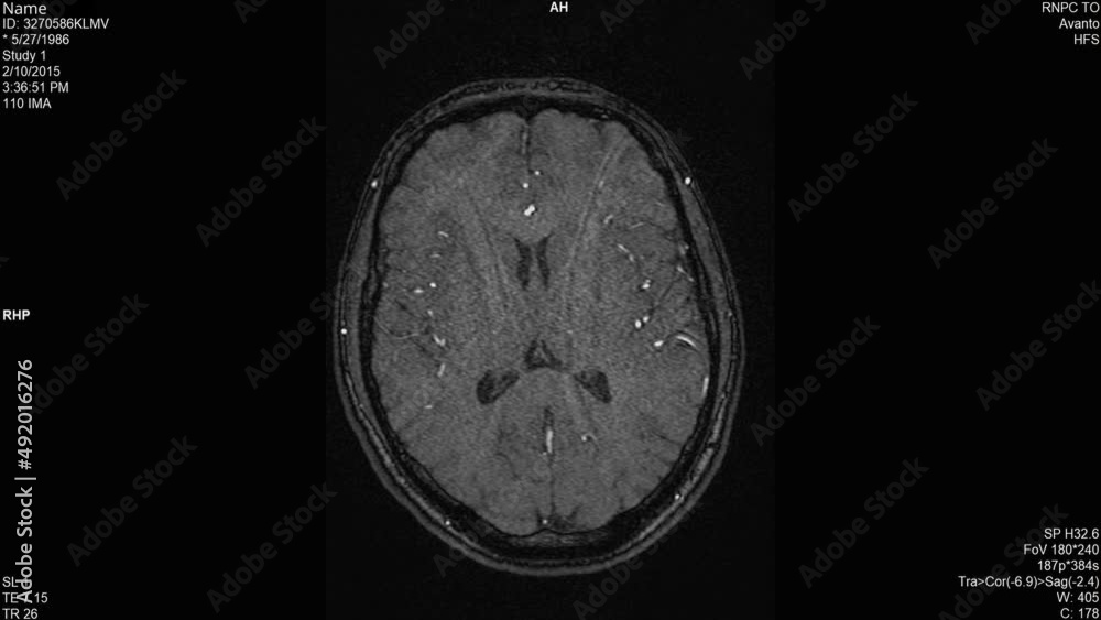 Magnetic resonance images of the brain (MRI brain), Time of flight ...