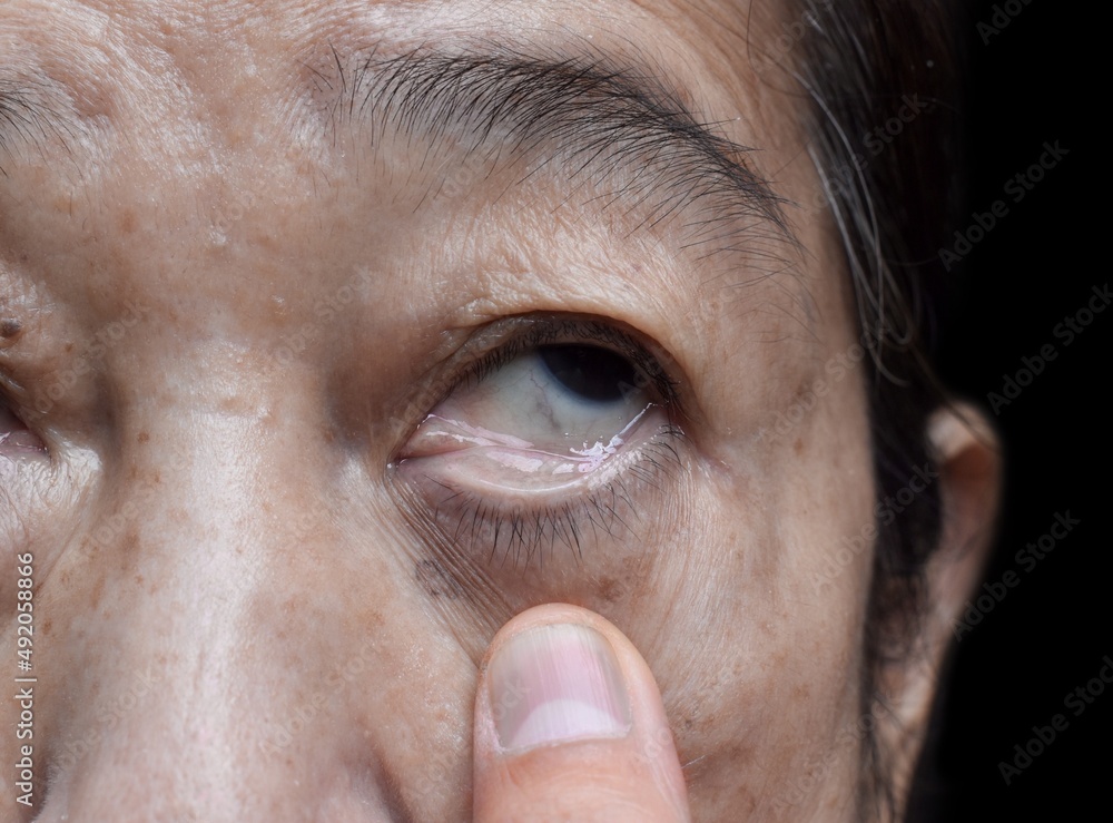 Pale skin of Asian woman. Sign of anemia. Pallor at eyelid. Stock Photo ...