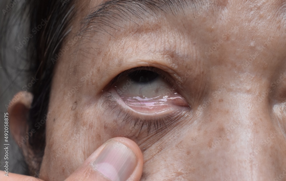 Pale skin of Asian woman. Sign of anemia. Pallor at eyelid. Stock Photo ...