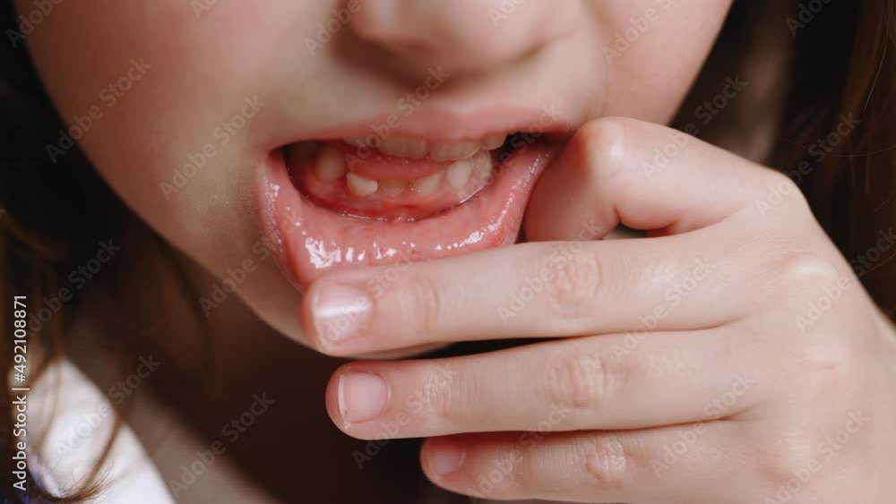 Child loosens his milk tooth. Cute little girl of 7-9 years old is losing milk teeth. Changing ...