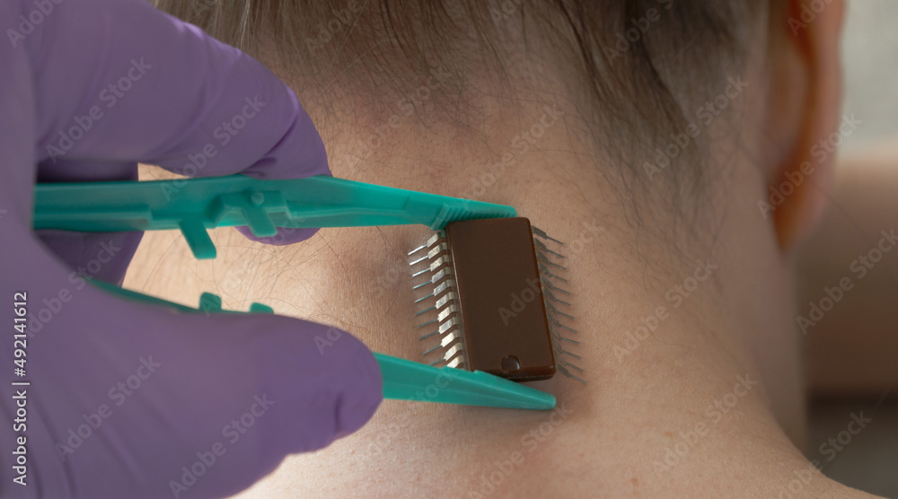 implantation of a microchip under human skin. selective focus. Human ...
