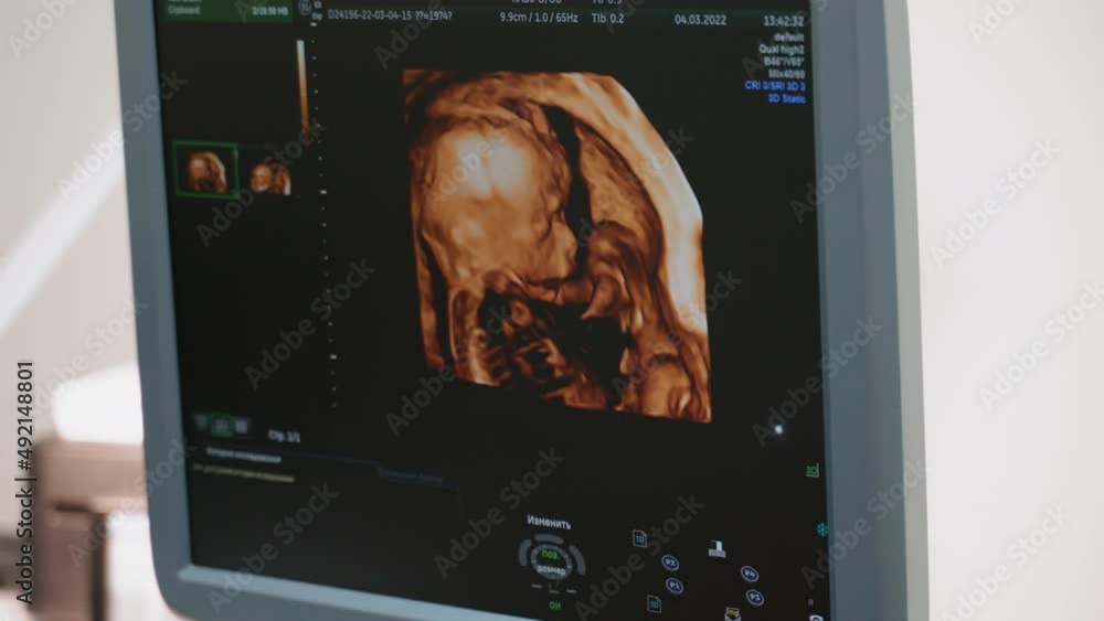 Vídeo do Stock: Ultrasonic screen. Image of the fetus in the womb ...