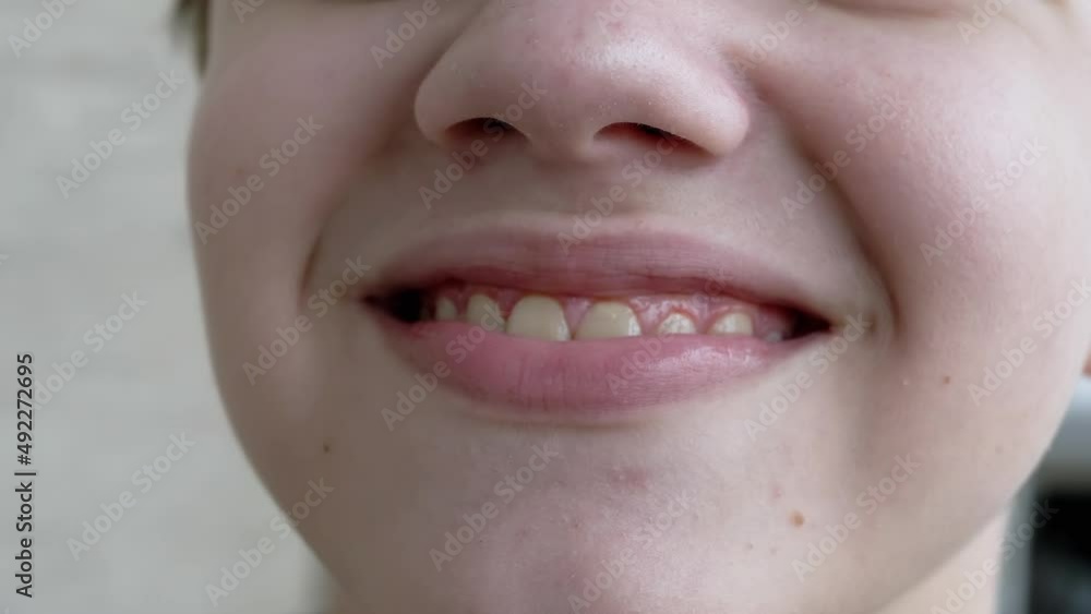 Close-up of the Face of a Smiling Child Showing Teeth. Teenager ...