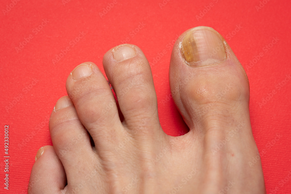Toenails with fungus problems,Onychomycosis, also known as tinea ...
