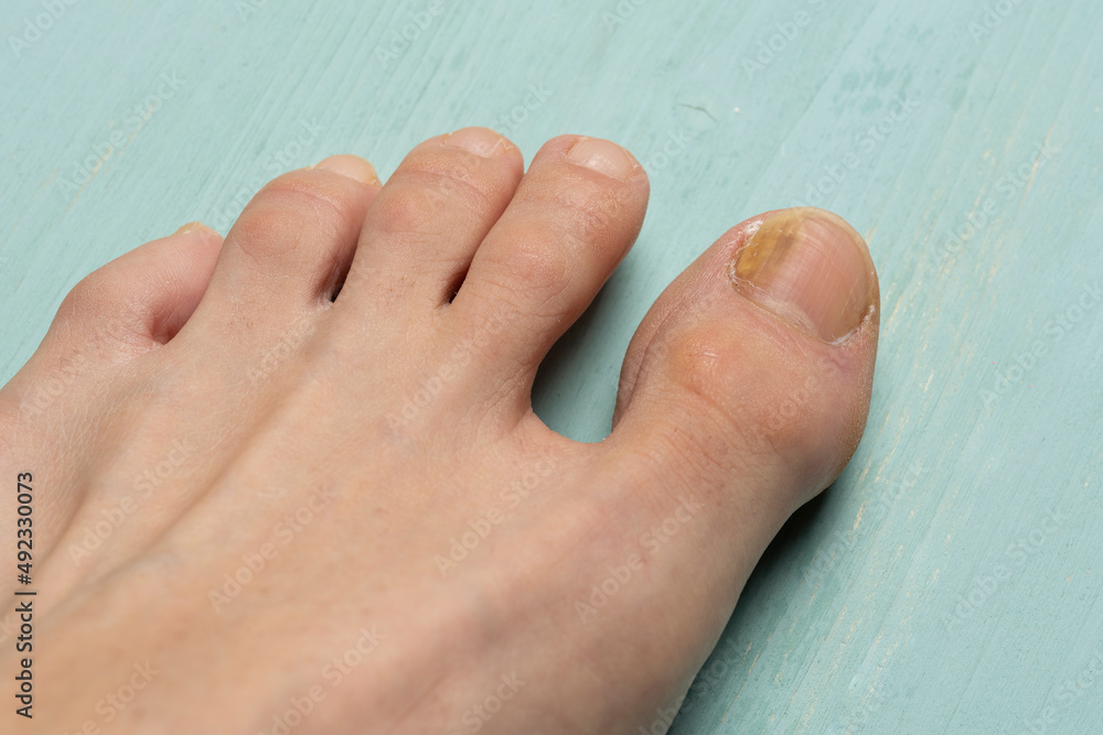Toenails with fungus problems,Onychomycosis, also known as tinea ...