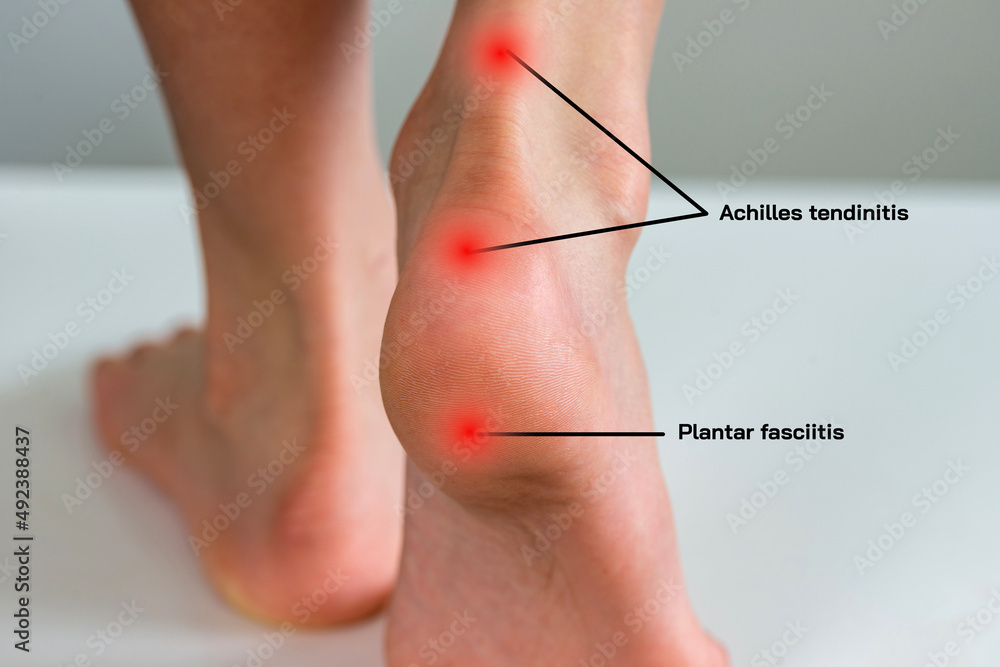 Close Up Human Heel With Red Spots Point At Pain In Achilles Tendon In close-up-human-heel-with-red-spots-point-at-pain-in-achilles-tendon-in