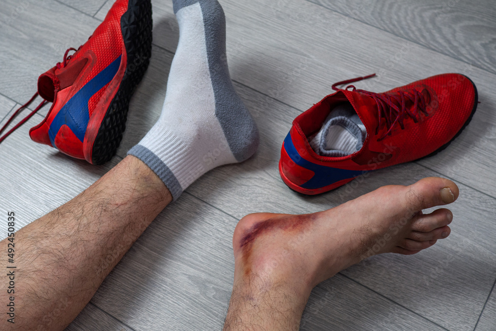 Ankle injury with dislocation and sprains. Fracture or Leg sprain ...