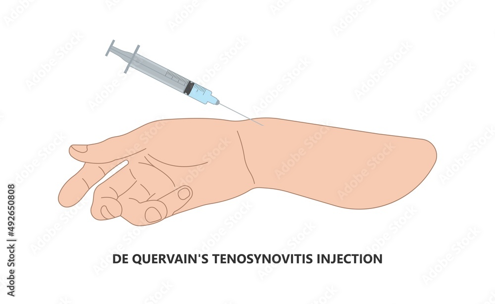 De quervain's pain tendon thumb wrist hurt grasp make a fist sport ...