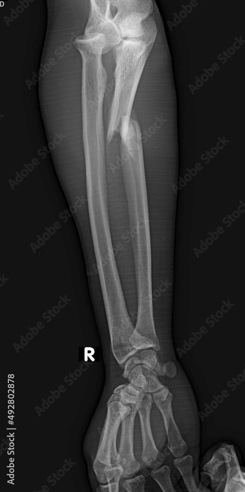 Ulna Fracture X Ray