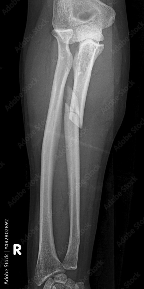 monteggia fracture, proximal ulna fracture with radial head dislocation ...