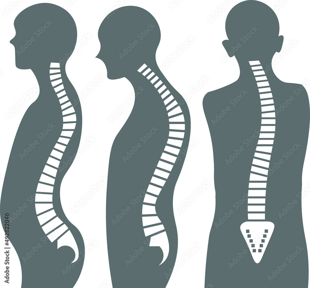 three types of spine deformities vector illustration art khyposis ...