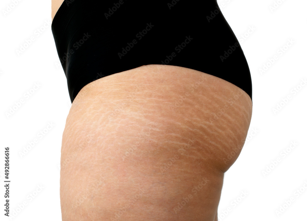White Stretch Marks On Legs