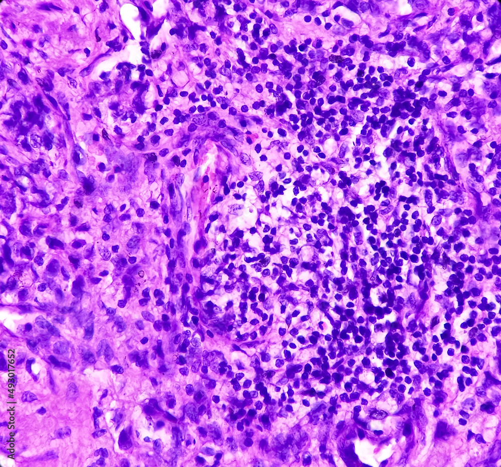 Prostate Cancer(TURP): Microscopic image of prostatic tissue ...